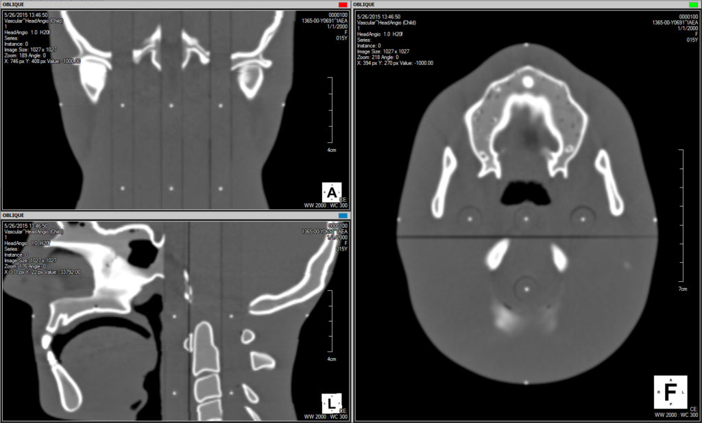 Phantom Patient for VMAT & IMRT - CIRS
